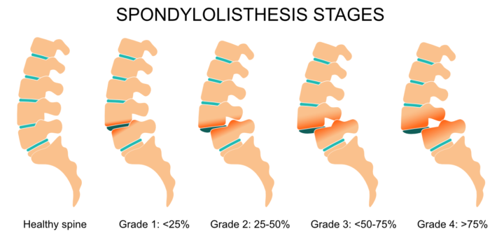 Where to begin with spondylolisthesis and back pain - Sequence Wiz